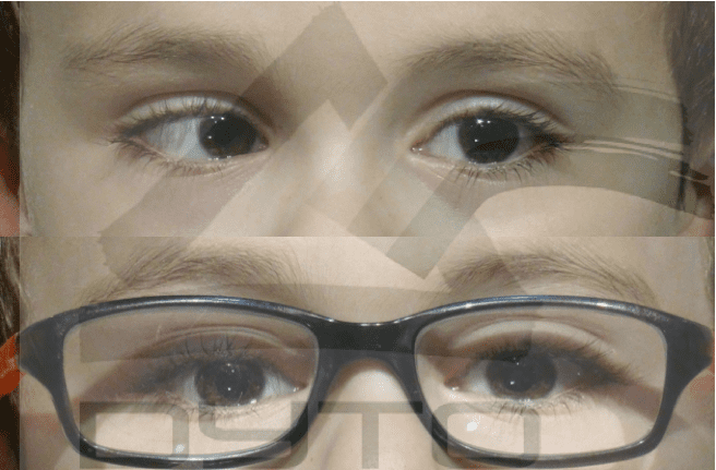 ¿Gafas para siempre? - Clínica oftalmológica DYTO