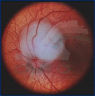Retinoblastoma - Clínica oftalmológica DYTO